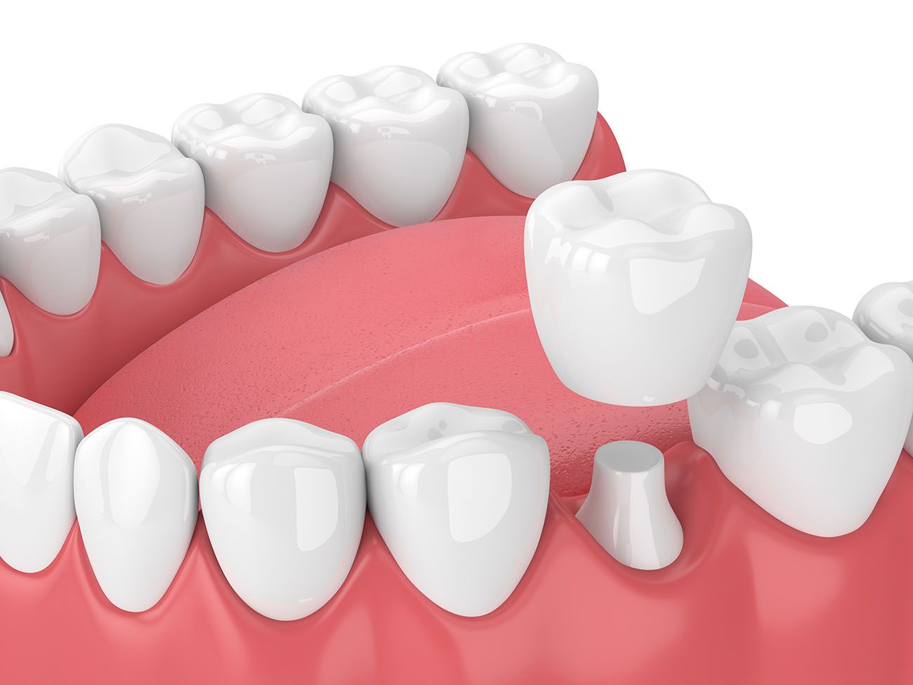 How Do Dental Crowns Help My Smile? - Gaithersburg, MD Dentist